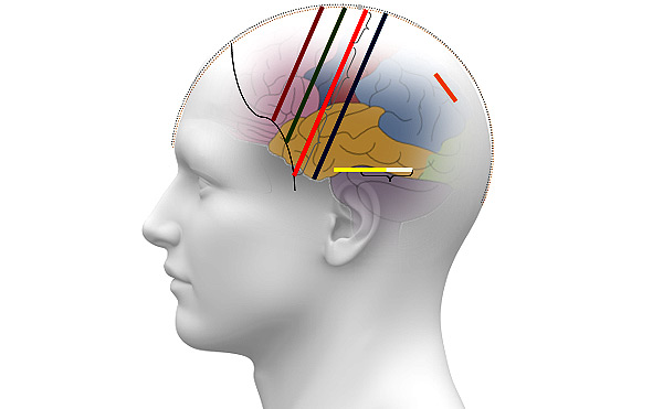 CPD - London Academy of Chinese Acupuncture (LACA)